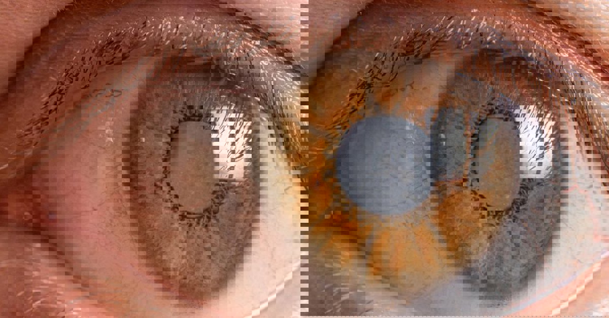 Understanding Trabeculectomy: A Glaucoma Surgery Guide