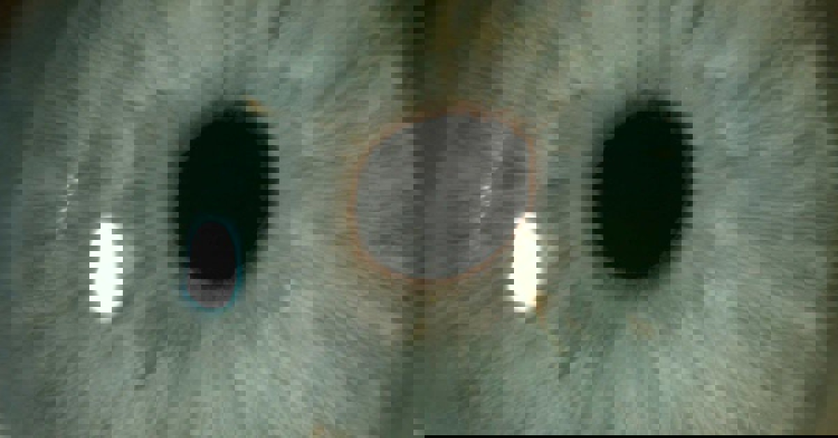 Who invented laser eye surgery - What is its history?