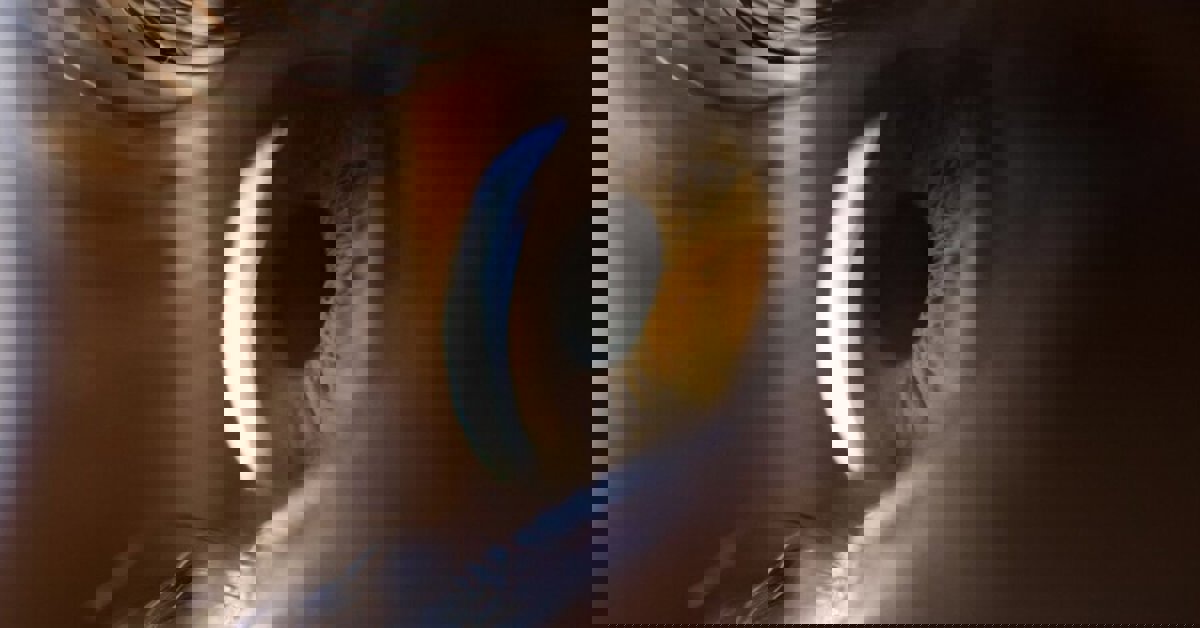 Fuchs; dystrophy: cataract surgery or corneal transplantation